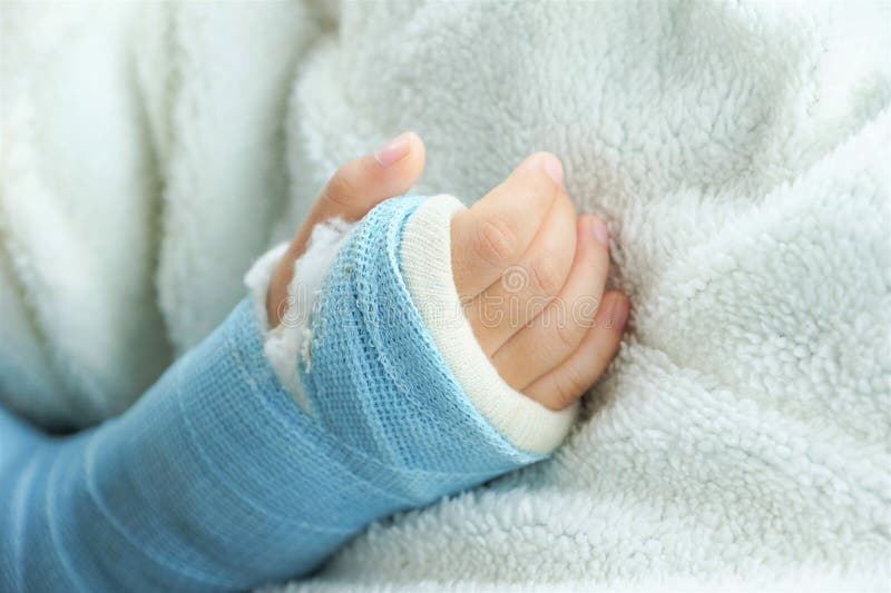Boy Hand Bone Broken from Accident with Arm Splint Stock Photo - Image ...