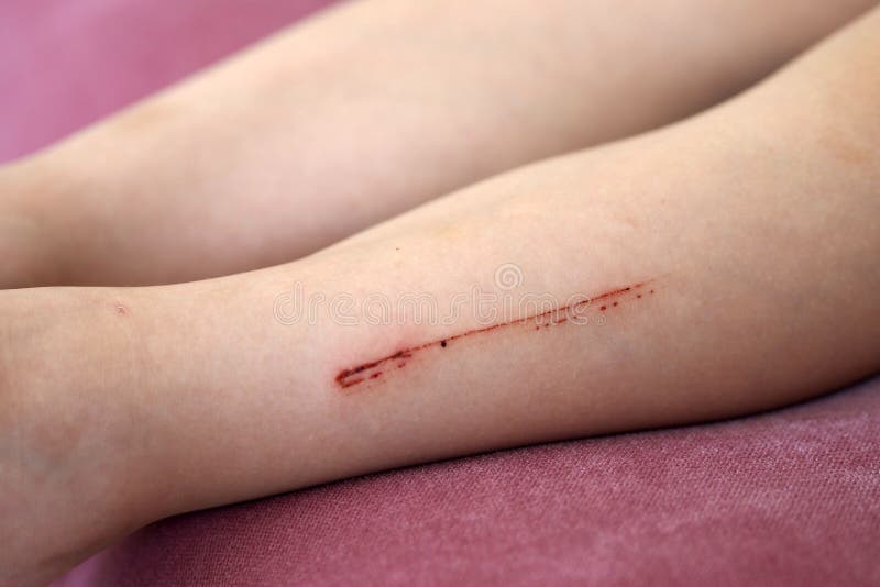 A Child`s Injured Leg, a Child`s Scratched and Injured Leg Stock Photo ...