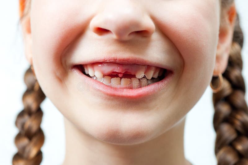 In the Child`s Mouth, Two Upper Front Milk Teeth Were Torn Out Stock ...