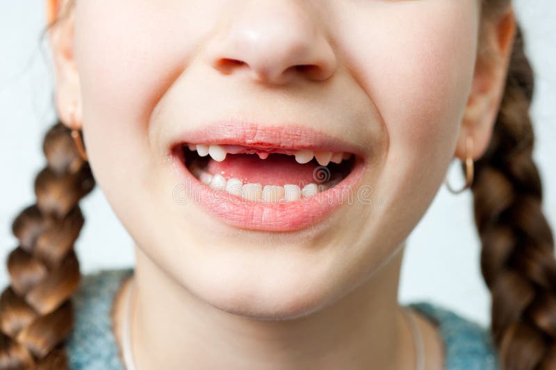 In the Child`s Mouth, Two Upper Front Milk Teeth Were Torn Out Stock ...