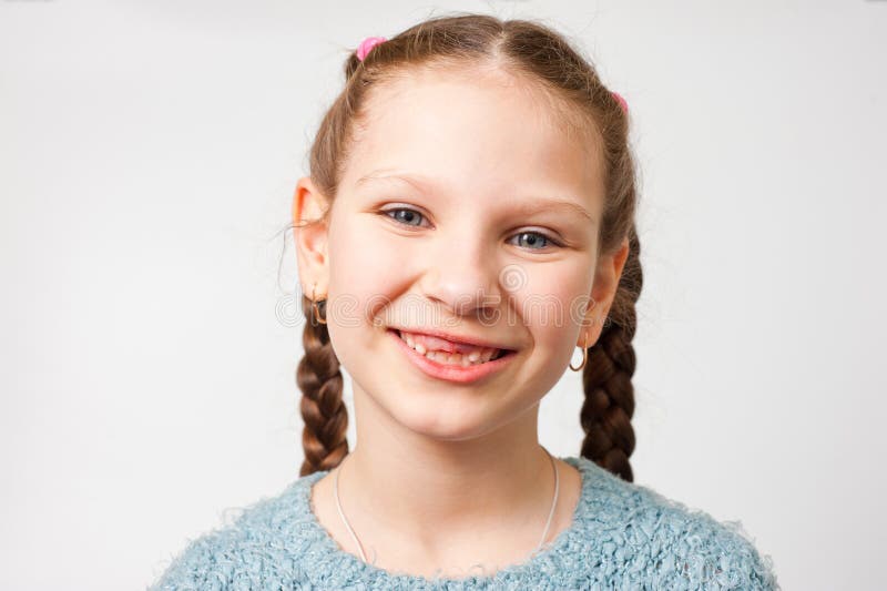 In the Child`s Mouth, Two Upper Front Milk Teeth Were Torn Out Stock ...