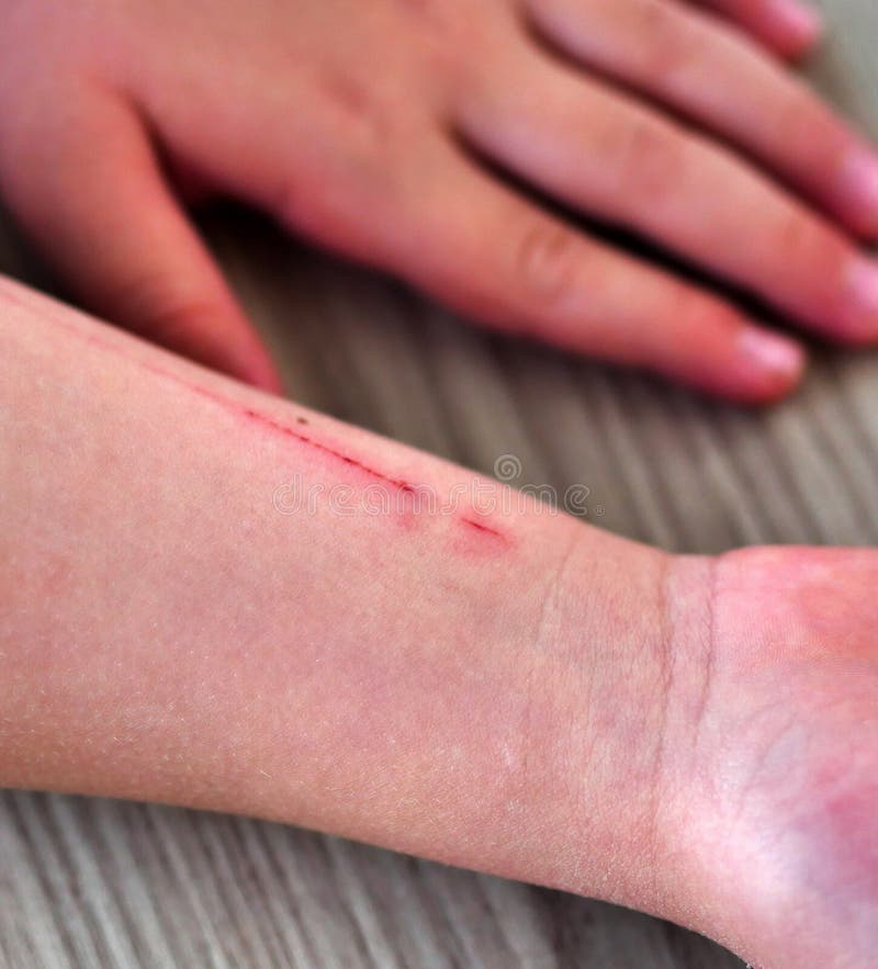 A Child`s Scratched and Injured Arm,arm Injuries Stock Image - Image of ...