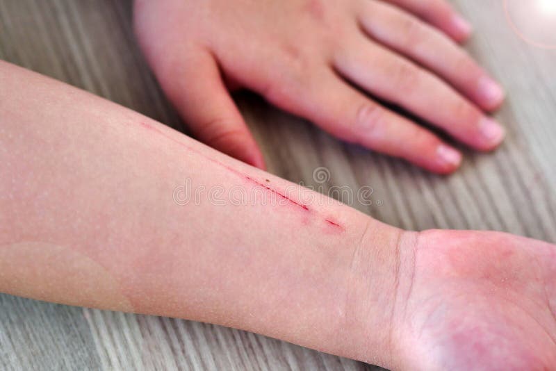 A Child`s Scratched and Injured Arm,arm Injuries Stock Photo - Image of ...