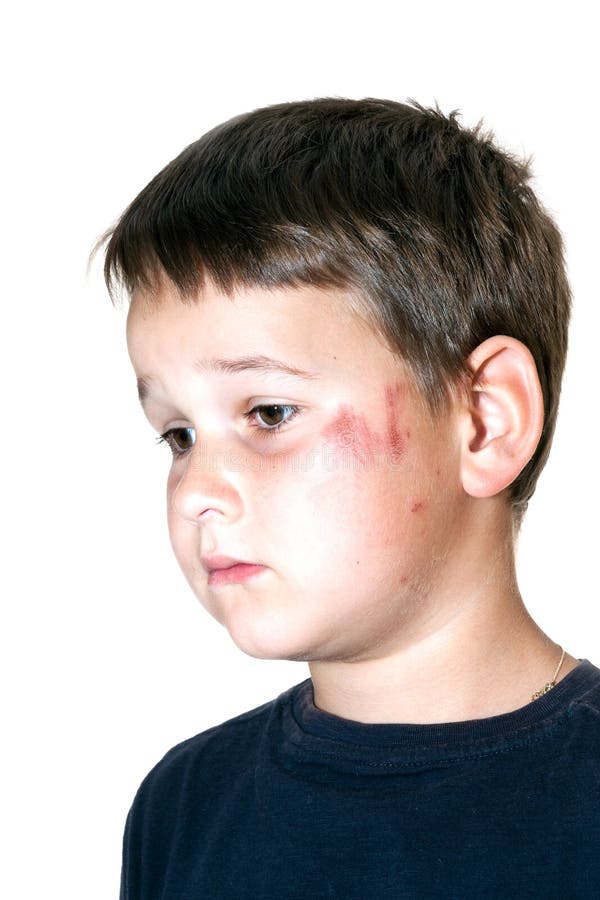 Child with a scraped face stock photo. Image of human - 55015142