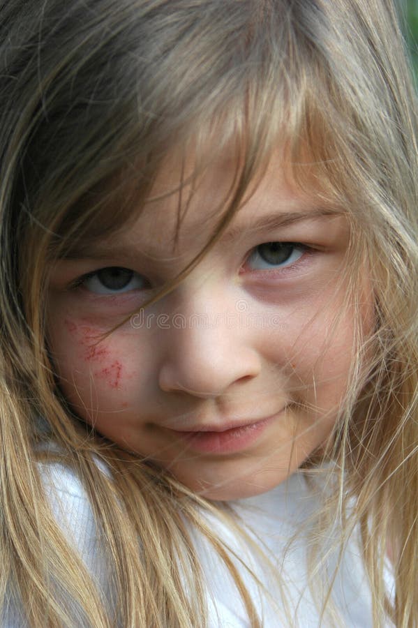 Child with scrapes stock image. Image of scrape, girl - 3553329