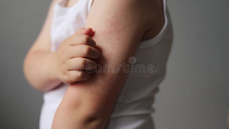 Child Scratching Arm with Red Rash Stock Footage - Video of dermatitis ...