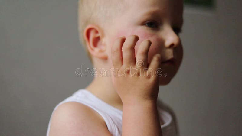 Child Scratching Face with Red Rash Stock Video - Video of face, health ...