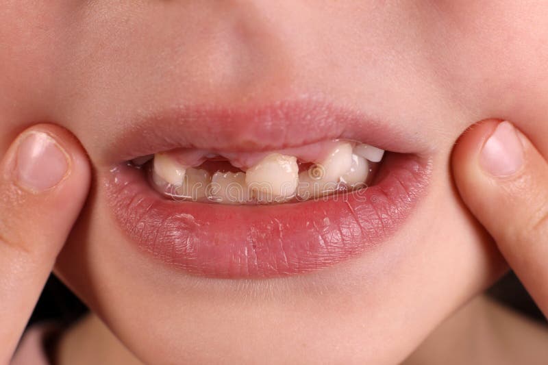 Child Showing Lost Baby Teeth Stock Image - Image of girl, clean: 276399237