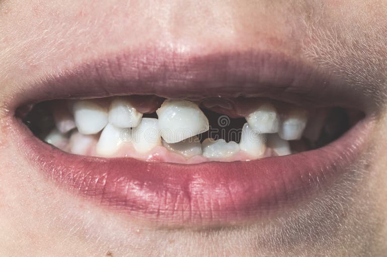 Child shows missing teeth stock image. Image of loss - 66617317