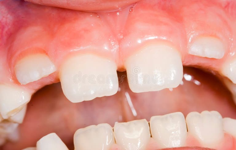 132 Dental Eruption Freemont Stock Photos - Free & Royalty-Free Stock ...