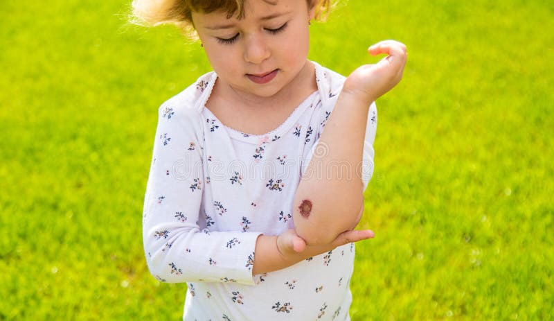 Child Wound on Hand. Selective Focus Stock Image - Image of closeup ...