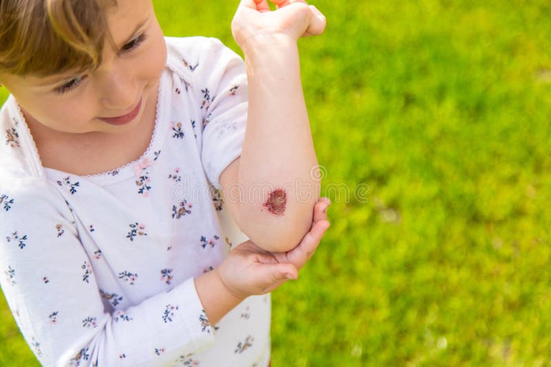 Child Wound on Hand. Selective Focus Stock Image - Image of hurt, pain ...