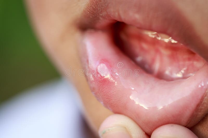 Bacterial Infection On Lips