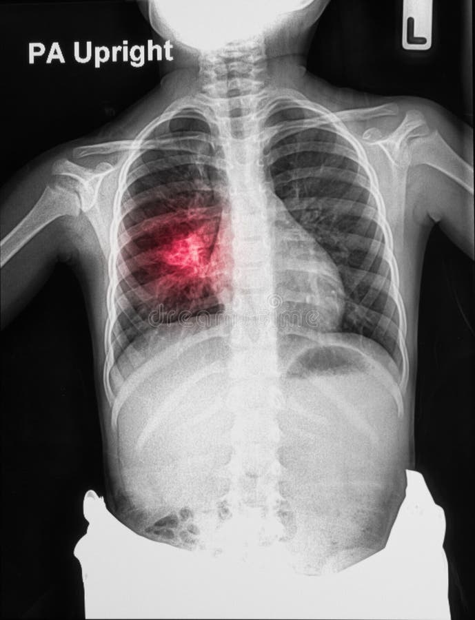 Children chest X-rays stock image. Image of body, abdomen - 28480751