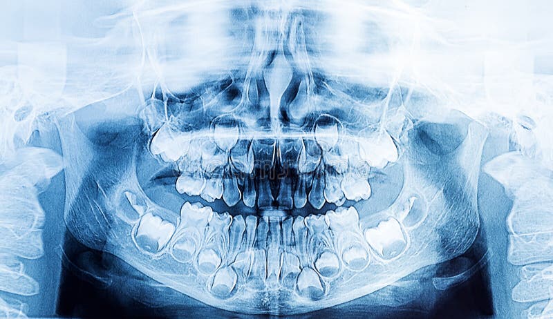 Children Dental X-ray with Calf`s Teeth Stock Image - Image of ...