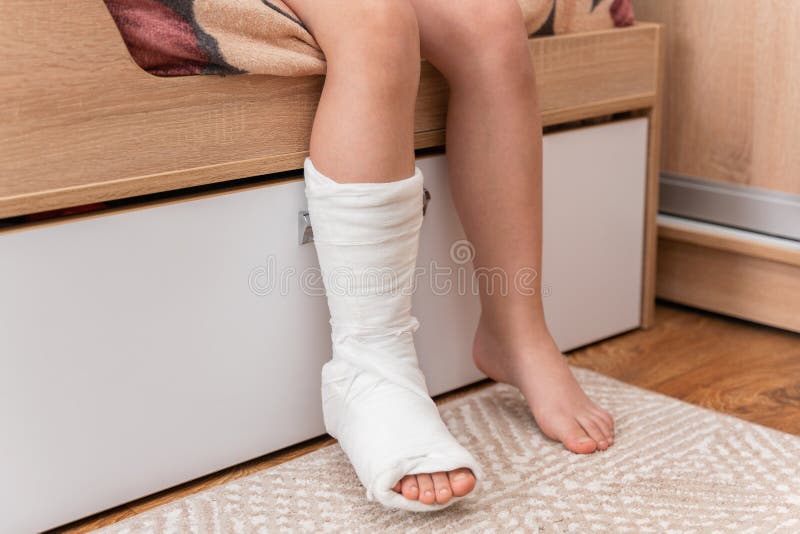 Children S Legs, One Leg is Broken and in a Cast Stock Photo - Image of ...
