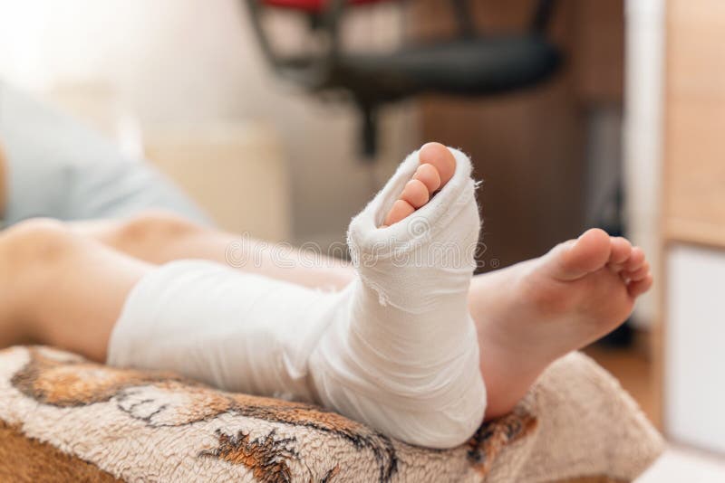 Children S Legs, One Leg is Broken and in a Cast Stock Image - Image of ...