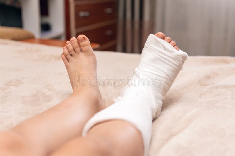 Children S Legs, One Leg is Broken and in a Cast Stock Image - Image of ...