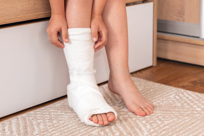 Children S Legs, One Leg is Broken and in a Cast Stock Image - Image of ...