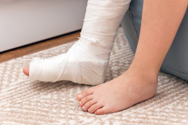 Children S Legs, One Leg is Broken and in a Cast Stock Photo - Image of ...