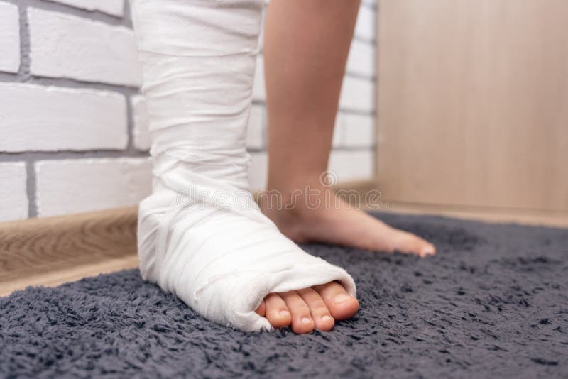 Children S Legs, One Leg is Broken and in a Cast Stock Photo - Image of ...