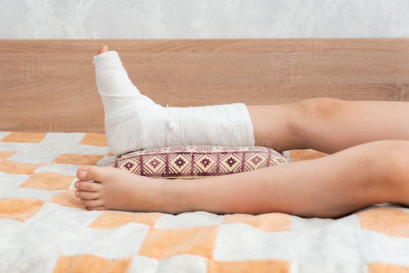 Children S Legs, One Leg is Broken and in a Cast Stock Photo - Image of ...