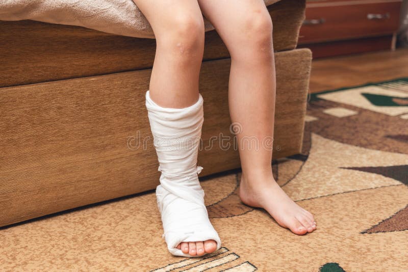 Children S Legs, One Leg is Broken and in a Cast Stock Photo - Image of ...