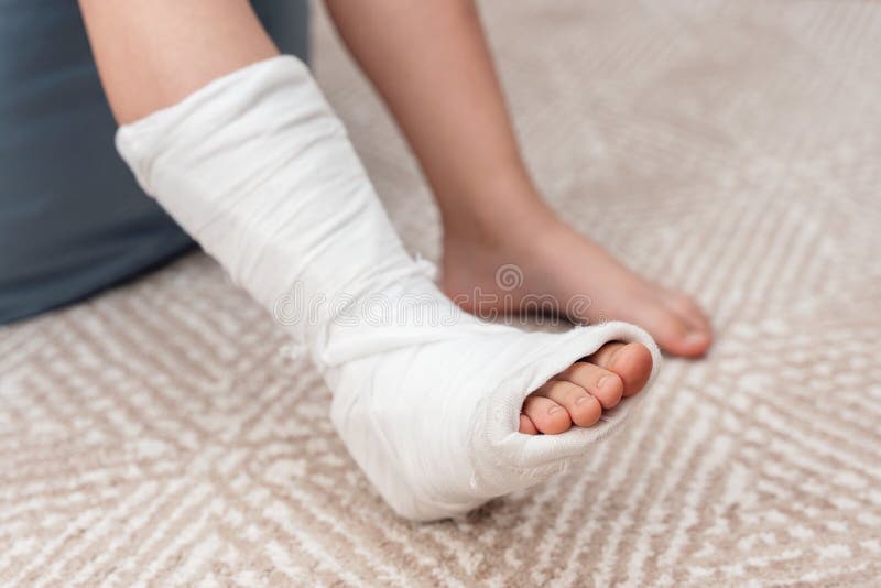 Children S Legs, One Leg is Broken and in a Cast Stock Image - Image of ...