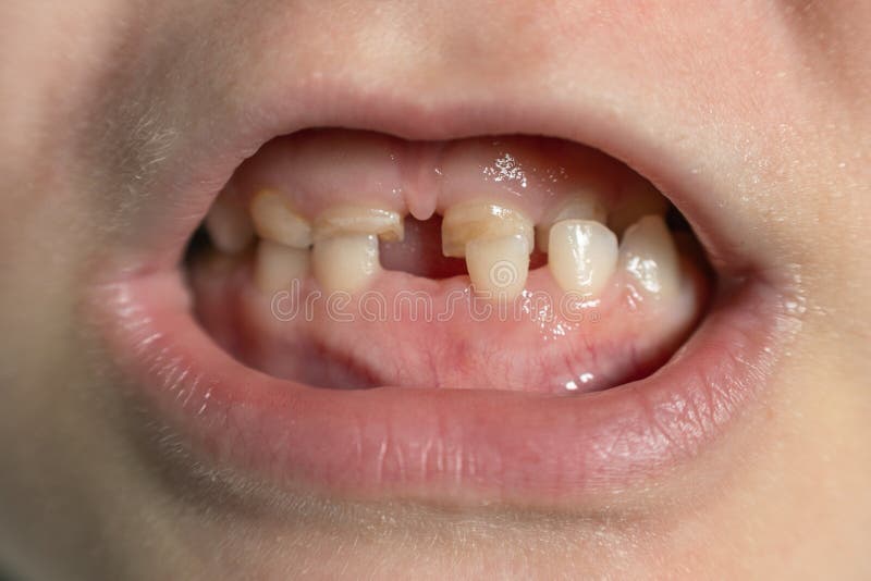 Children`s Mouth with Fallen and Broken Milk Teeth Stock Photo - Image ...