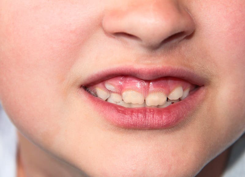 Children`s Teeth. the Molar Grows in the Second Row Stock Image - Image ...