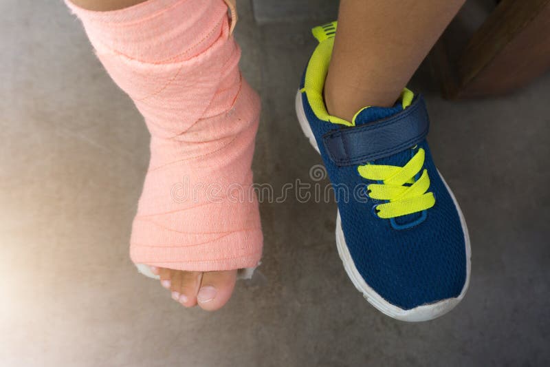 Children Wearing a Splint of Leg Broken from Injury Stock Image - Image ...