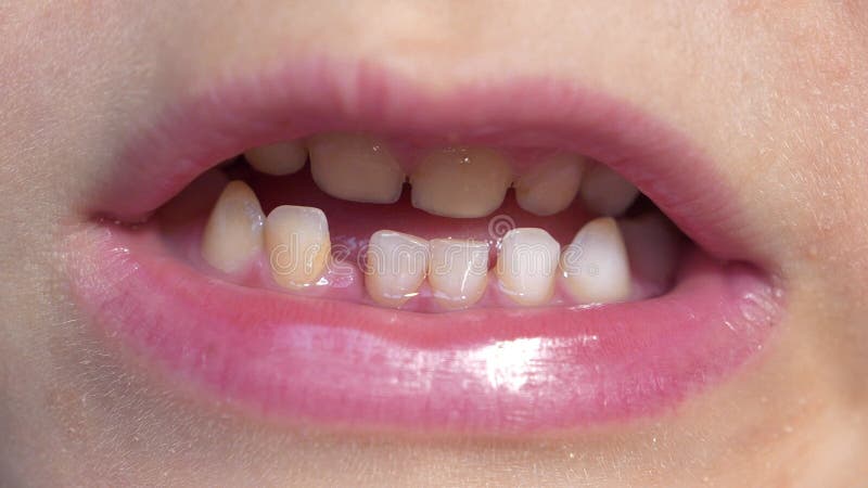 Childs Mouth. Teeth of 5 Year Old Boy Stock Footage - Video of child ...