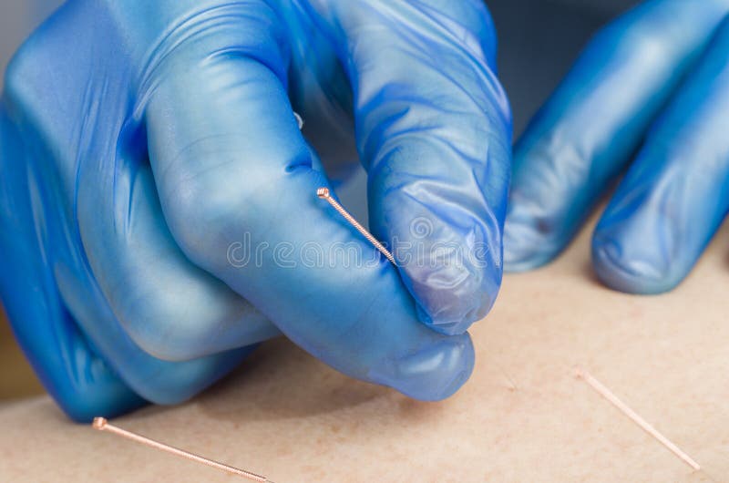 Chinese Medicine Doing Acupuncture. Stock Image - Image of hand, blue ...