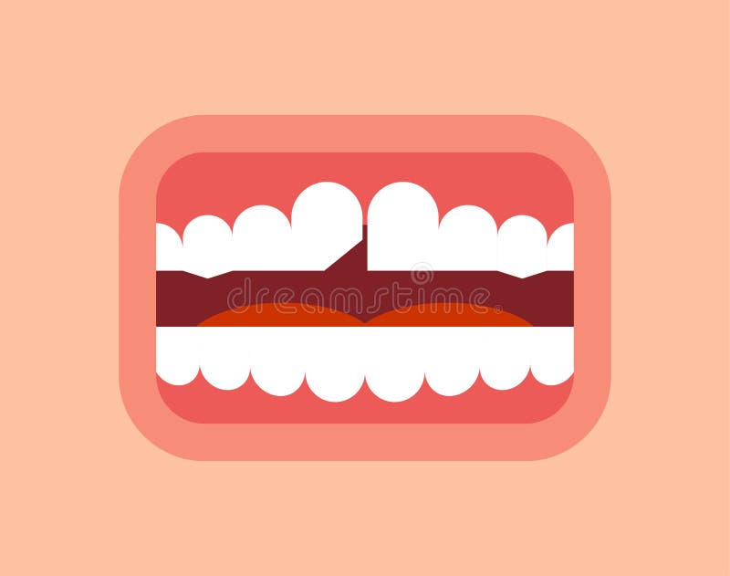 Chipped Tooth in Mouth. Broken Tooth Stock Vector - Illustration of ...