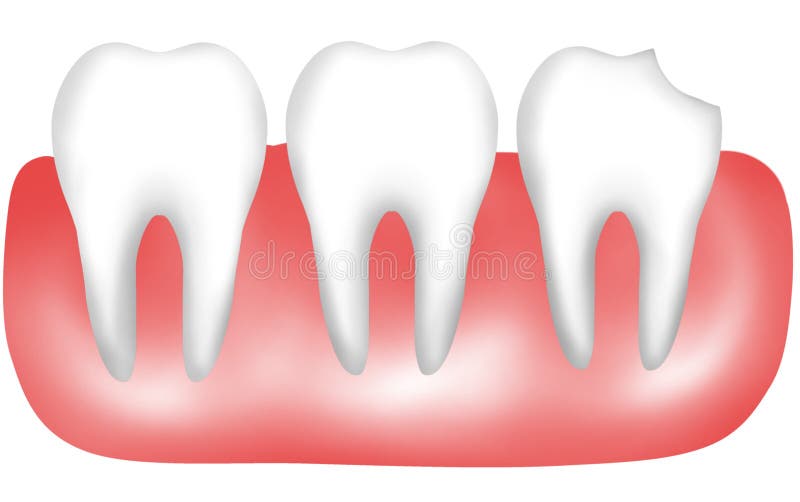 A Chipped Tooth Occurs when a Piece of the Tooth Structure Breaks Off ...