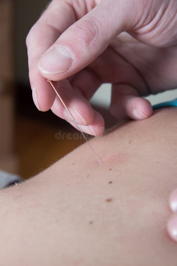 Chiropractor Using Acupuncture Needle Target Area Stock Image - Image ...
