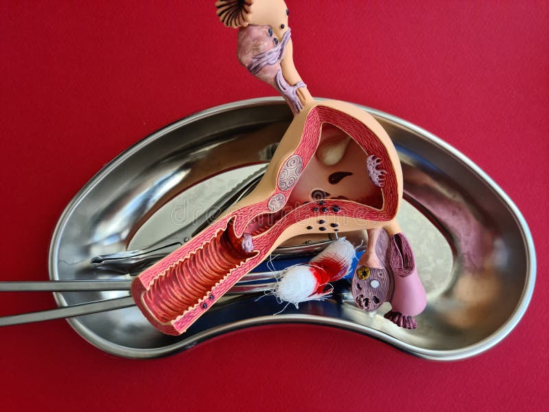 Chirurgie Van De Geslachtsorganen Van De Baarmoeder En De Eierstokken