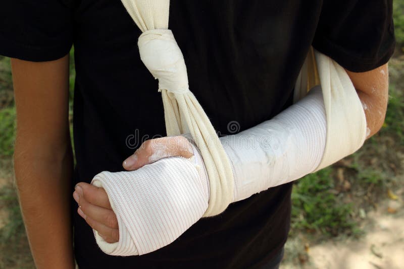 4,686 Braccio Gesso Foto - Foto Stock Gratis e Royalty-Free da Dreamstime