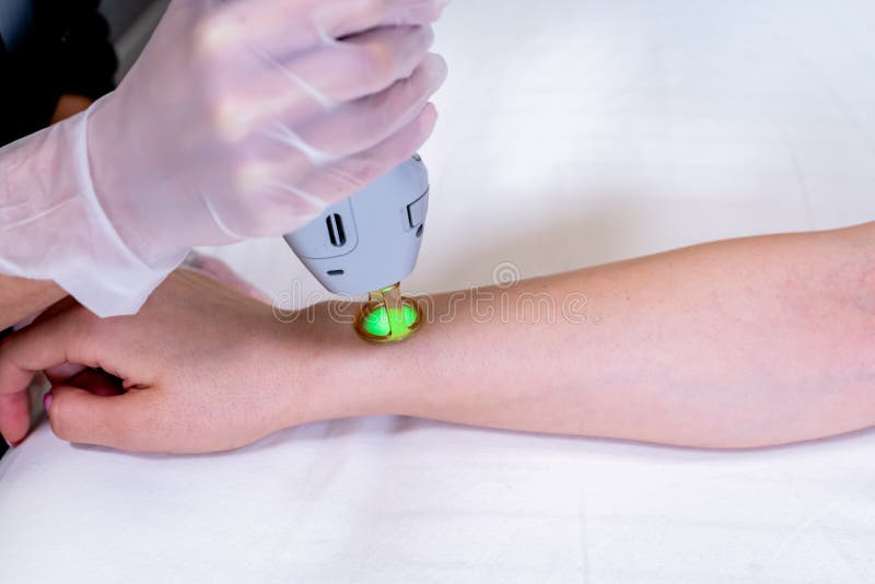 Chiusura Di Una Sessione Di Rimozione Dei Capelli Con Un Braccio Laser ... Chiusura Di Una Sessione Di Rimozione Dei Capelli Con Un Braccio Laser ...