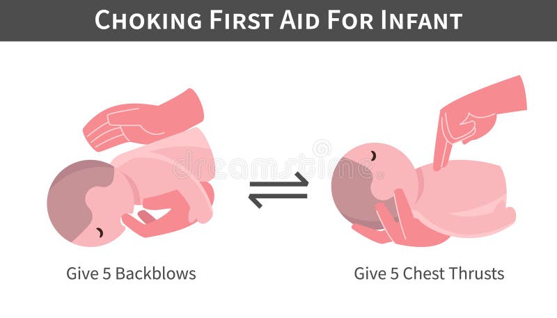 Choking First Aid for Infant Cartoon Illustration . Back Blows and ...