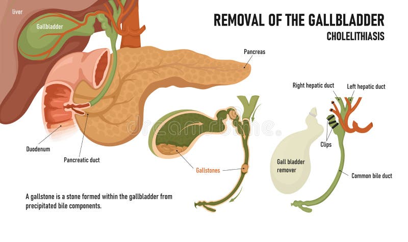 Cholecystitis. Inflammation of the Gallbladder and Bile Ducts. Removal ...