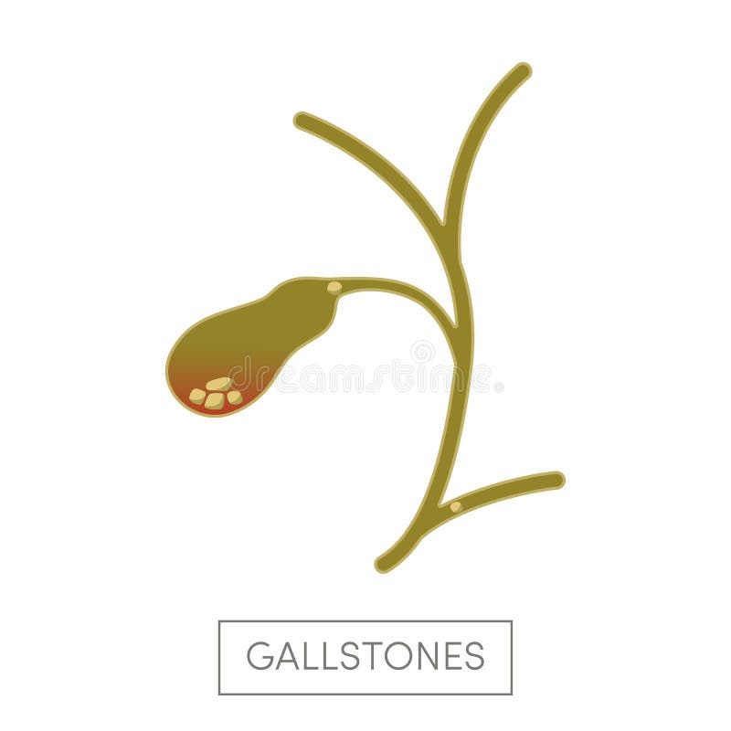 Gallstones. Cholelithiasis. Cholecystitis. Inflammation of the ... Gallstones. Cholelithiasis. Cholecystitis. Inflammation of the ...