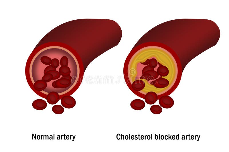Hyperlipidemia Stock Illustrations – 189 Hyperlipidemia Stock ...