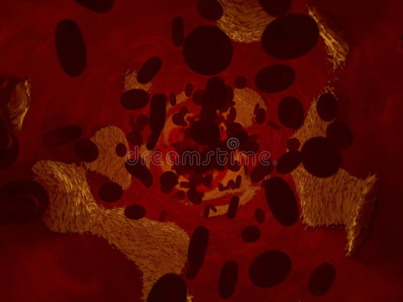 Cholesterol Inside Blood Vessel. Stock Illustration - Illustration of ...