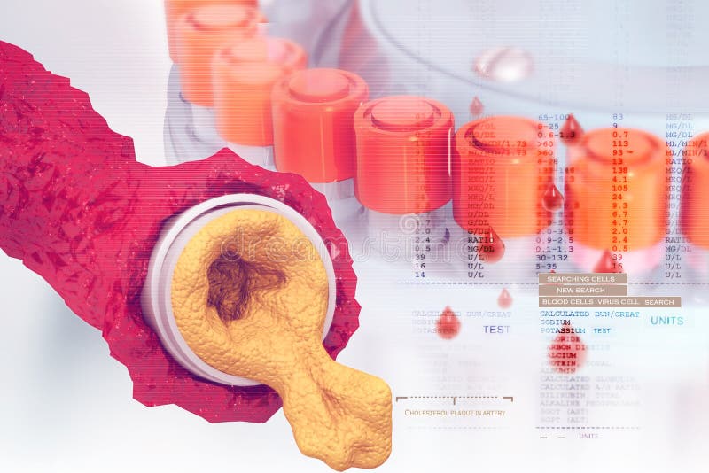 Cholesterol Plaque in Artery Stock Illustration - Illustration of ...