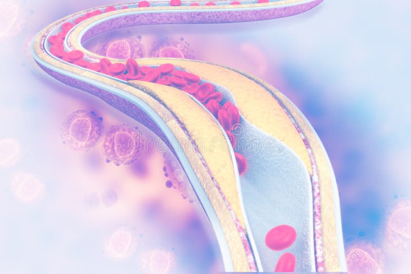 Cholesterol Plaque in Artery Stock Illustration - Illustration of blood ...