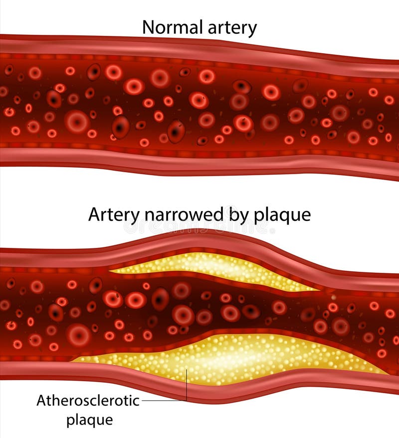 Cholesterol Plaque in Artery. Artery Narrowed by Plaque and Normal ...