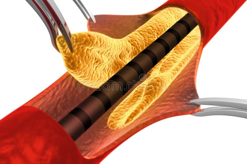 Cholesterol Plaque in Artery Stock Illustration - Illustration of ...