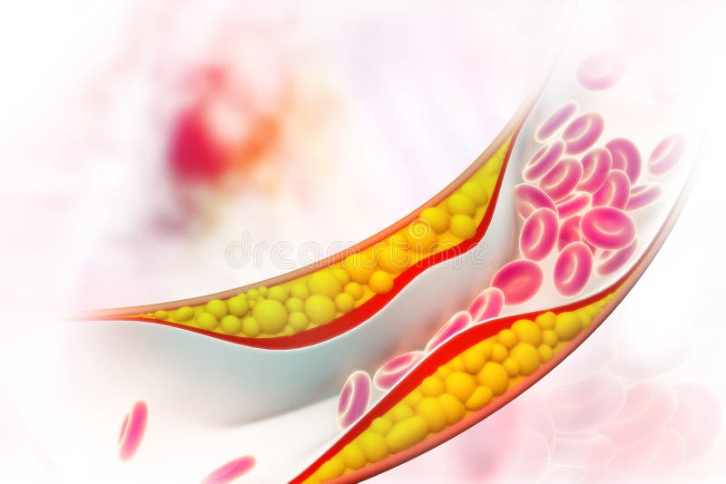 Cholesterol Plaque in Artery on Science Background Stock Illustration ...