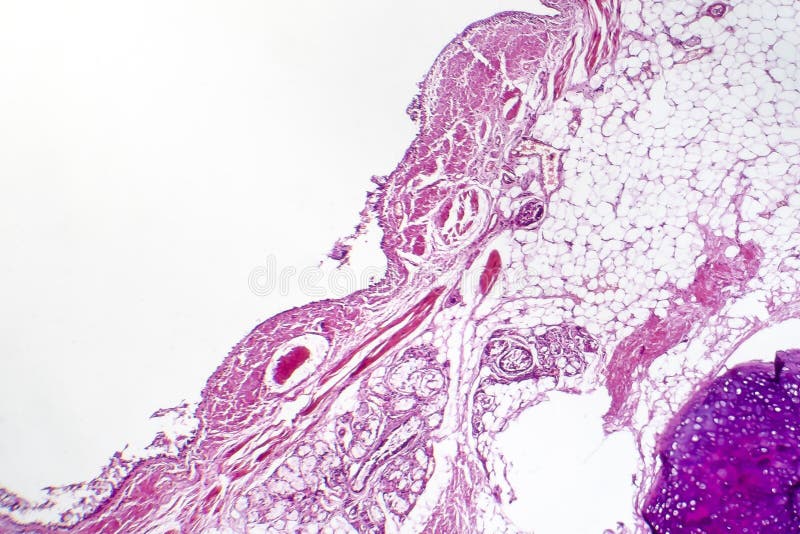 Chronic Bronchitis Under Microscope Stock Image - Image of microscopy ...